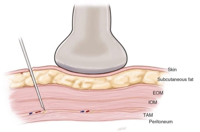 Ultrasound-Guided Transversus Abdominis Plane (TAP) Block - NYSORA