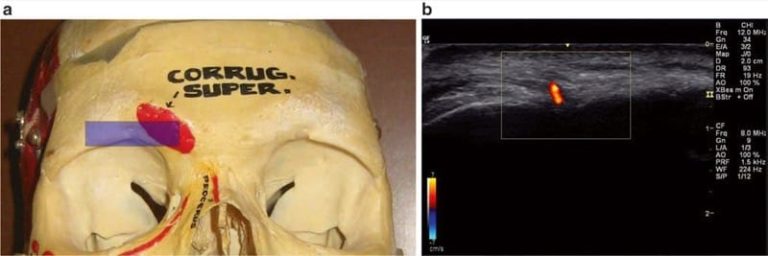 Ultrasound-Guided Superficial Trigeminal Nerve Blocks - NYSORA
