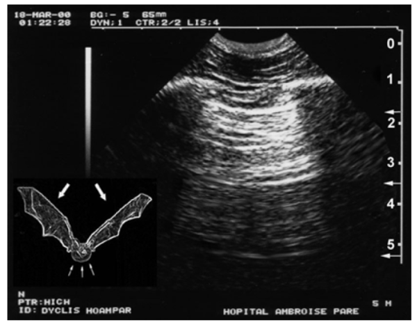 The Pleural Line - NYSORA