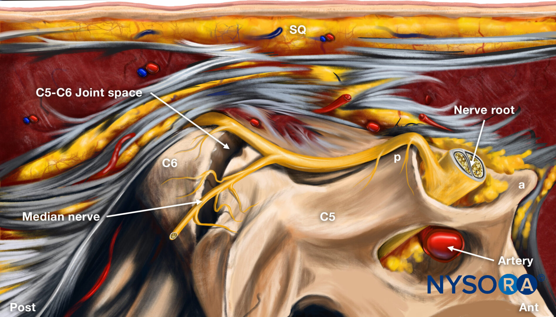 Inyección intraarticular (faceta) cigapofisaria cervical guiada por ...