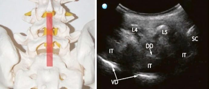 Ultrasound-Guided Lumbar Facet Nerve Block and Intra-articular ...