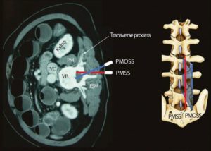 Ultrasound-Guided Central Neuraxial Blocks - NYSORA