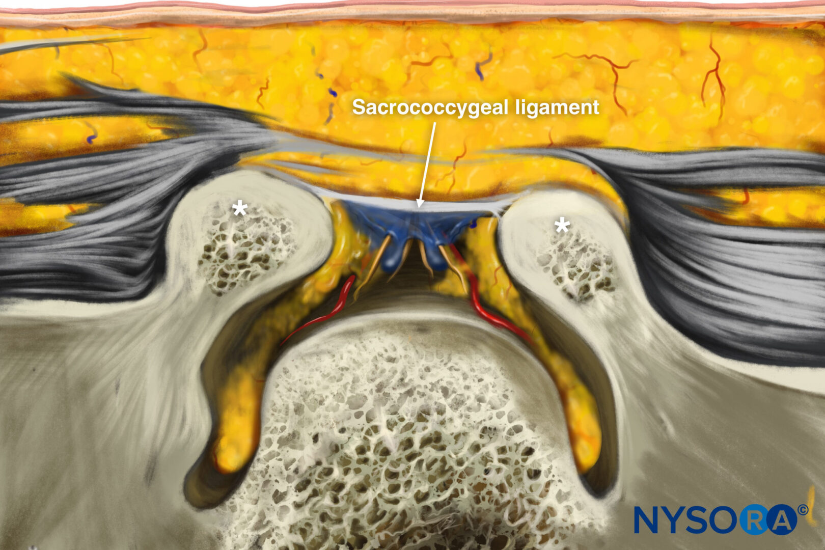 Inyecciones epidurales caudales guiadas por ultrasonido - NYSORA