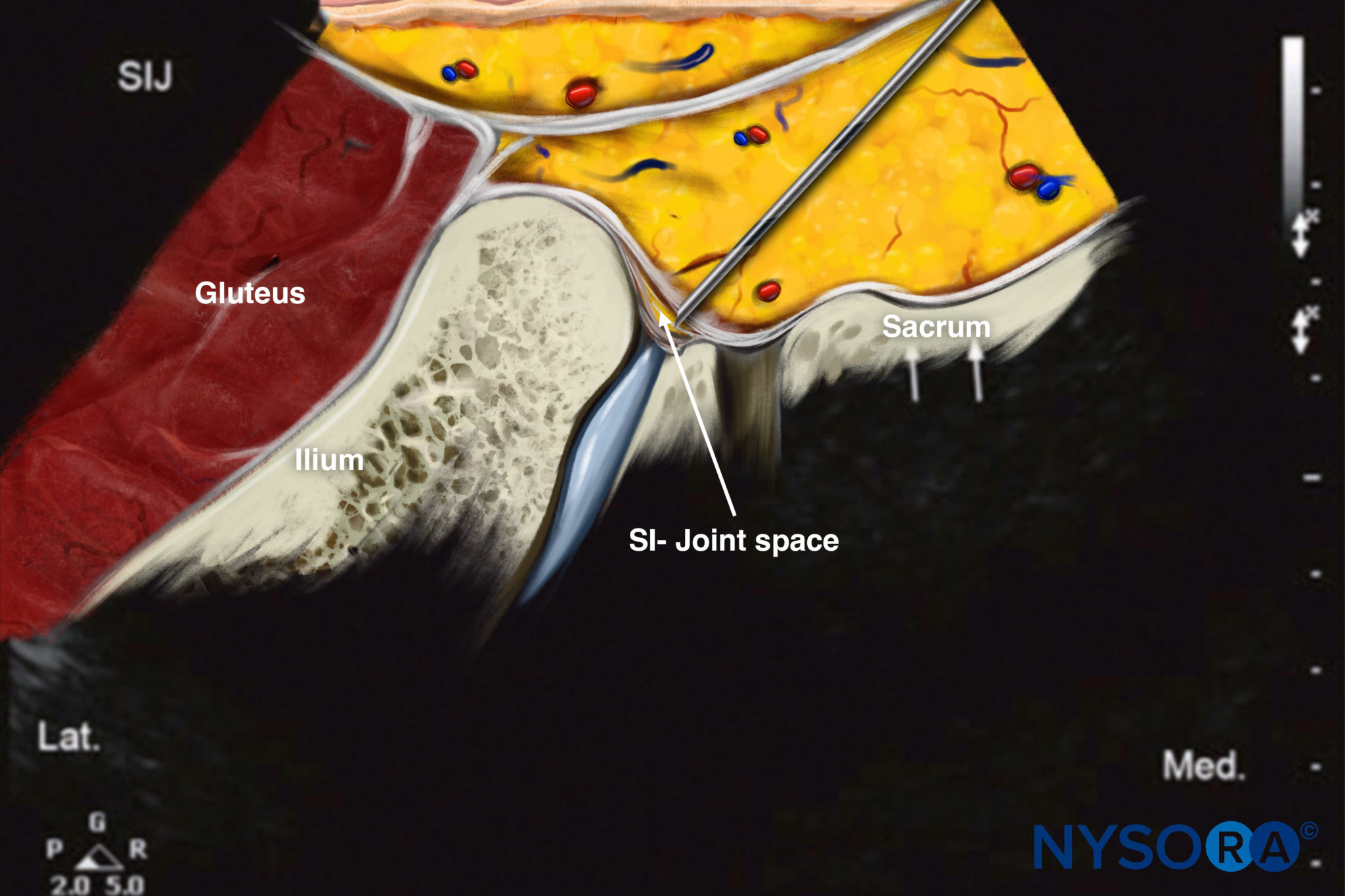 Ultrasound-Guided Sacroiliac Joint Injection - NYSORA