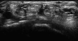 Ultrasound-Guided Hand, Wrist, and Elbow Injections - NYSORA