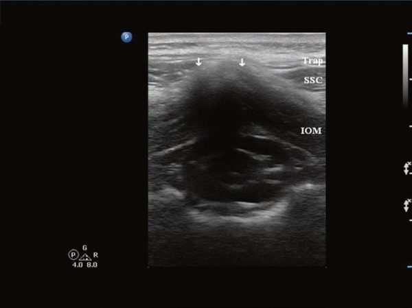 Occipital Neuralgia Sonoanatomy And Sonopathology Of The Occipital