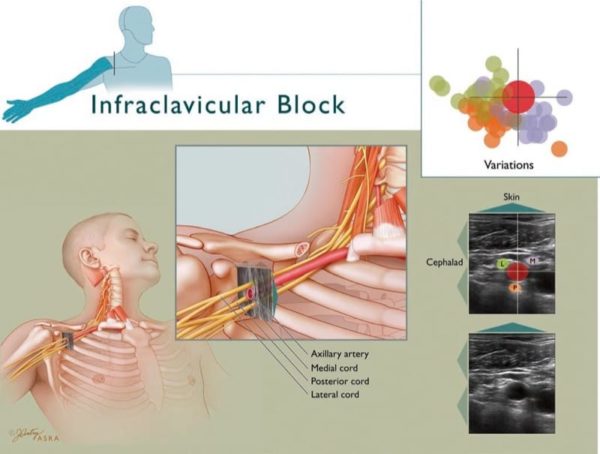 Ultrasound-Guided Upper Extremity Blocks - NYSORA