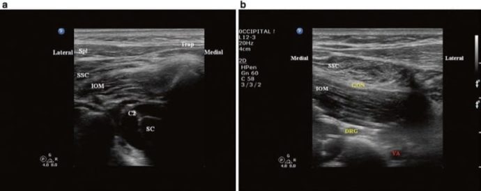 Okzipitale Neuralgie: Sonoanatomie und Sonopathologie der ...