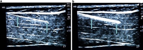 Ultrasound Technical Aspects: How to Improve Needle Visibility - NYSORA