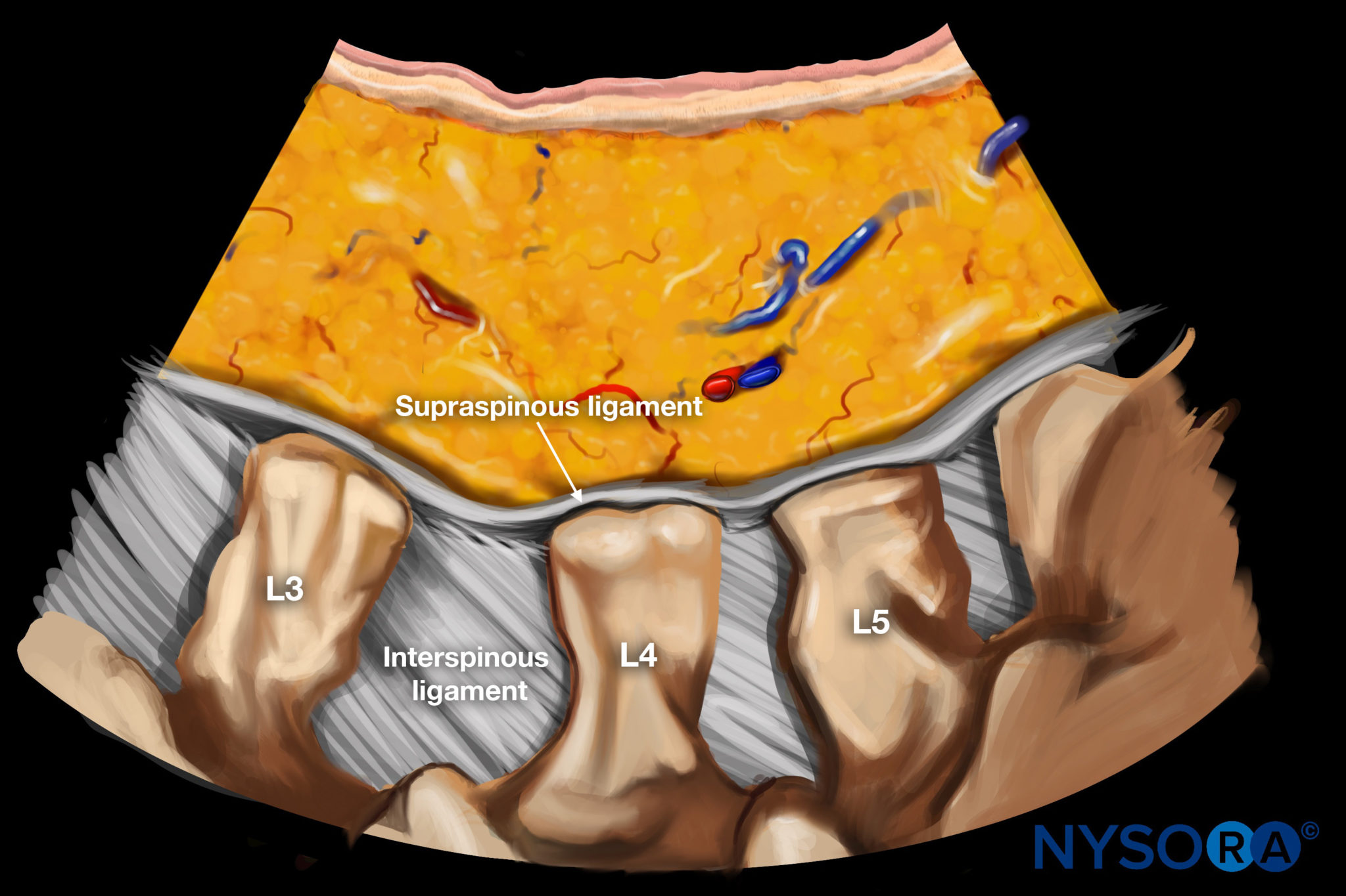 Ultrasound-Guided Lumbar Facet Nerve Block and Intra-articular ...