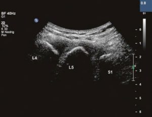 Ultrasound-Guided Lumbar Nerve Root (Periradicular) Injections - NYSORA
