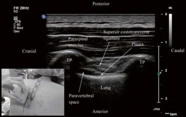Bloqueo paravertebral torácico guiado por ultrasonido - NYSORA