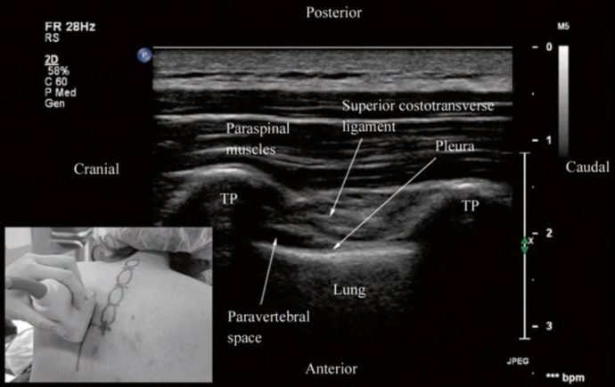 Ultrasound-Guided Thoracic Paravertebral Block - NYSORA