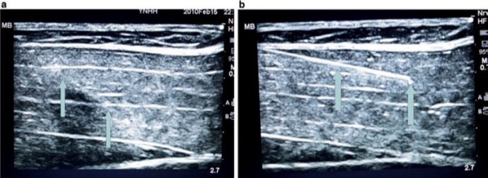 Ultrasound Technical Aspects: How to Improve Needle Visibility - NYSORA