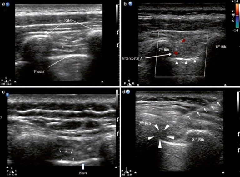 Ultrasound-Guided Peripheral Nerve block in Chronic Pain Management ...
