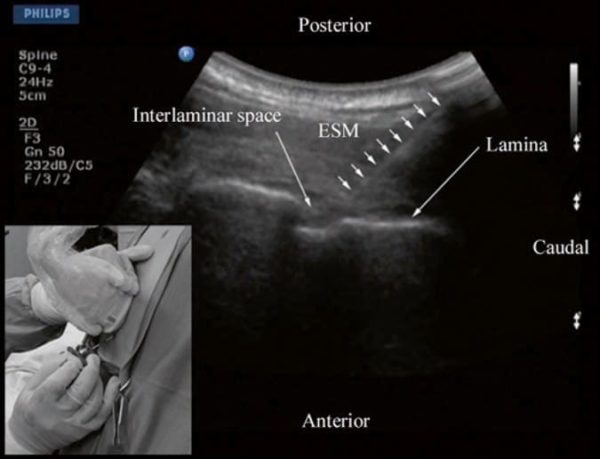 Ultrasound-Guided Central Neuraxial Blocks - NYSORA