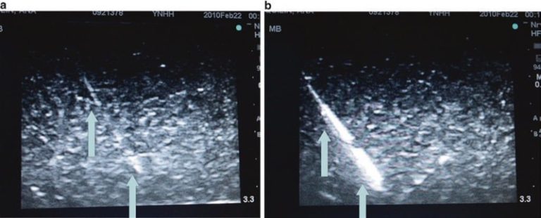 Ultrasound Technical Aspects: How to Improve Needle Visibility - NYSORA
