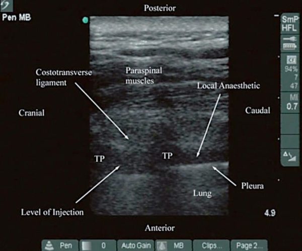 Ultrasound-Guided Thoracic Paravertebral Block - NYSORA
