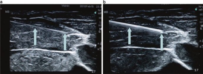 Ultrasound Technical Aspects: How to Improve Needle Visibility - NYSORA