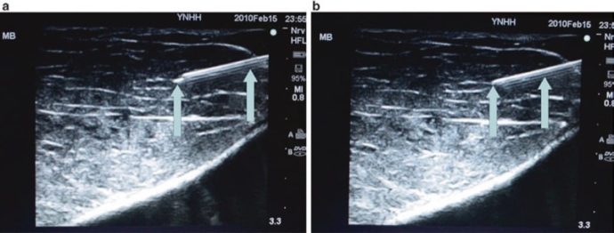 Ultrasound Technical Aspects: How to Improve Needle Visibility - NYSORA