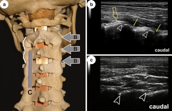 Spine Sonoanatomy for Pain Physicians - NYSORA