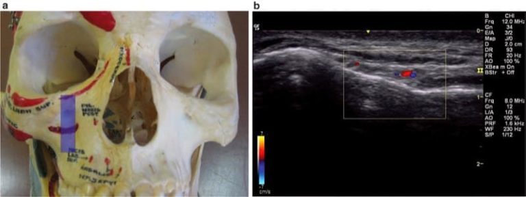 Ultrasound-Guided Superficial Trigeminal Nerve Blocks - NYSORA