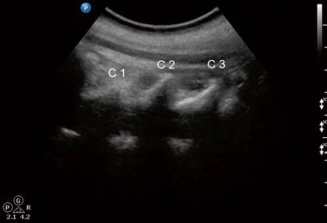 Ultrasound-Guided Cervical Zygapophyseal (Facet) Intra-Articular ...