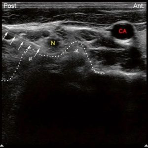 Ultrasound-Guided Cervical Nerve Root Block - NYSORA