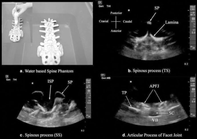 Ultrasound-Guided Central Neuraxial Blocks - NYSORA
