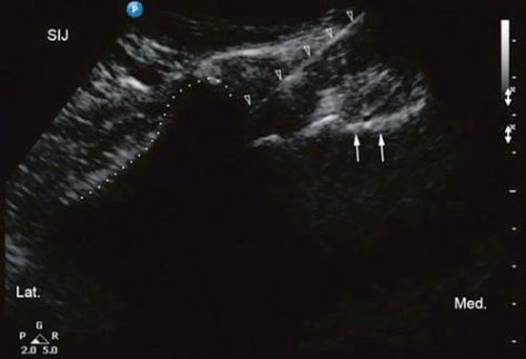 Ultrasound-Guided Sacroiliac Joint Injection - NYSORA
