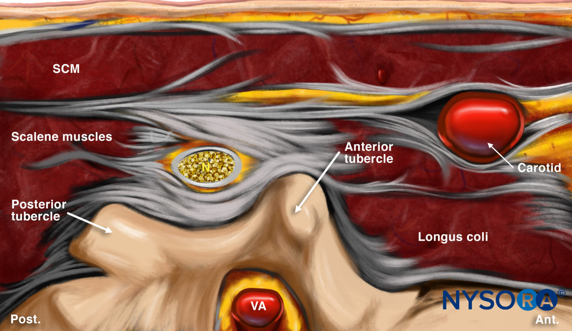 Bloqueo radicular del nervio cervical guiado por ecografía - NYSORA