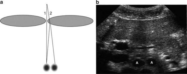 Basics of Ultrasound: Pitfalls and Limitations - NYSORA
