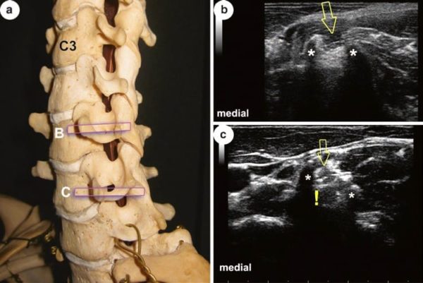 Spine Sonoanatomy for Pain Physicians - NYSORA