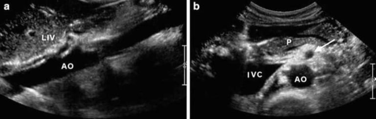 Bloc du plexus coeliaque et neurolyse guidés par ultrasons - NYSORA