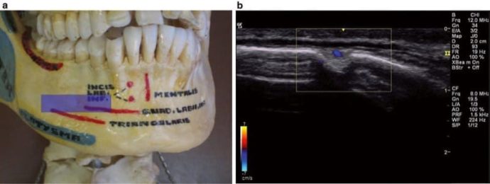 Ultrasound-Guided Superficial Trigeminal Nerve Blocks - NYSORA