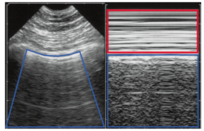 The Pleural Line - NYSORA
