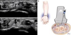 Ultrasound-Guided Hand, Wrist, and Elbow Injections - NYSORA