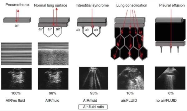 The Seven Principles of Lung Ultrasound - NYSORA