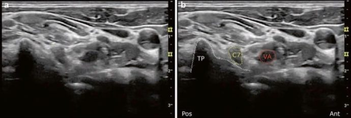 Ultrasound-Guided Cervical Nerve Root Block - NYSORA
