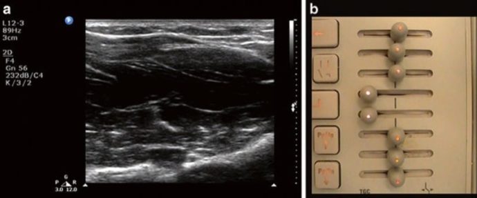 Essential Knobology for Ultrasound-Guided Regional Anesthesia and ...