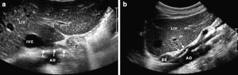 Bloc du plexus coeliaque et neurolyse guidés par ultrasons - NYSORA