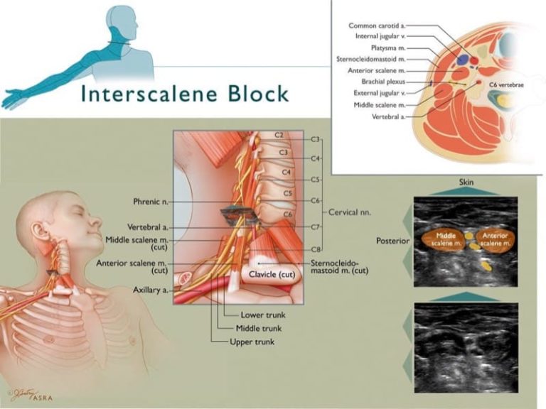 Ultrasound-Guided Upper Extremity Blocks - NYSORA