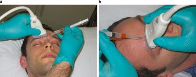 Ultrasound-Guided Superficial Trigeminal Nerve Blocks - NYSORA