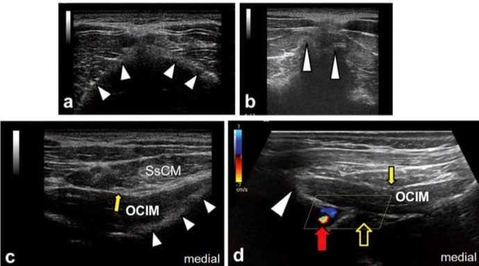 Bloqueo del nervio occipital mayor guiado por ecografía - NYSORA