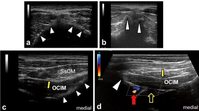 Ultrasound-Guided Greater Occipital Nerve Block - NYSORA