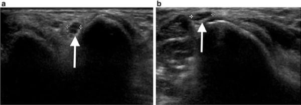 Ecografia dei nervi periferici - NYSORA