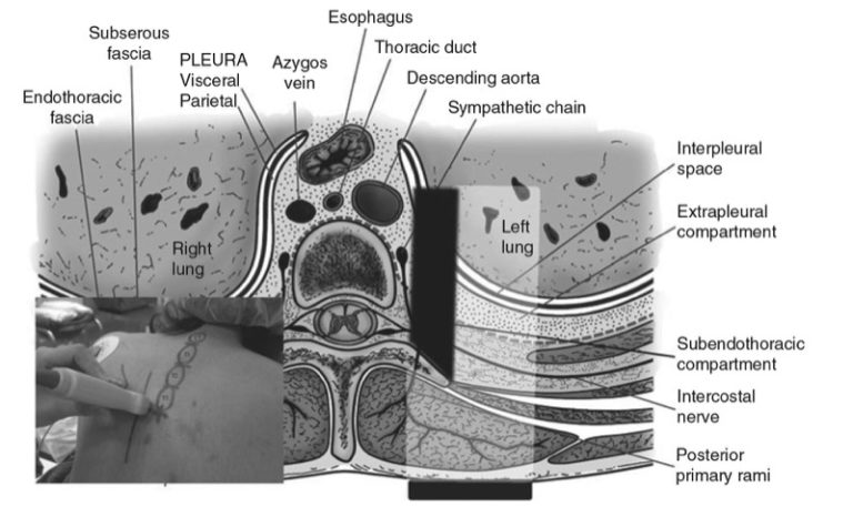 Ultrasound-Guided Thoracic Paravertebral Block - NYSORA