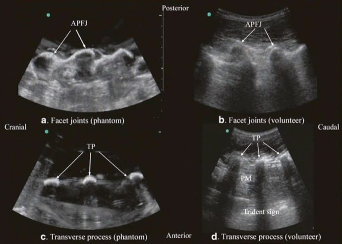 Bloques neuroaxiales centrales guiados por ultrasonido - NYSORA