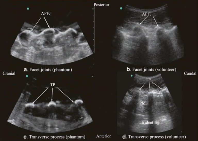 Ultrasound-Guided Central Neuraxial Blocks - NYSORA