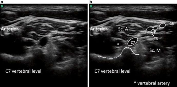 Ultrasound-Guided Upper Extremity Blocks - NYSORA